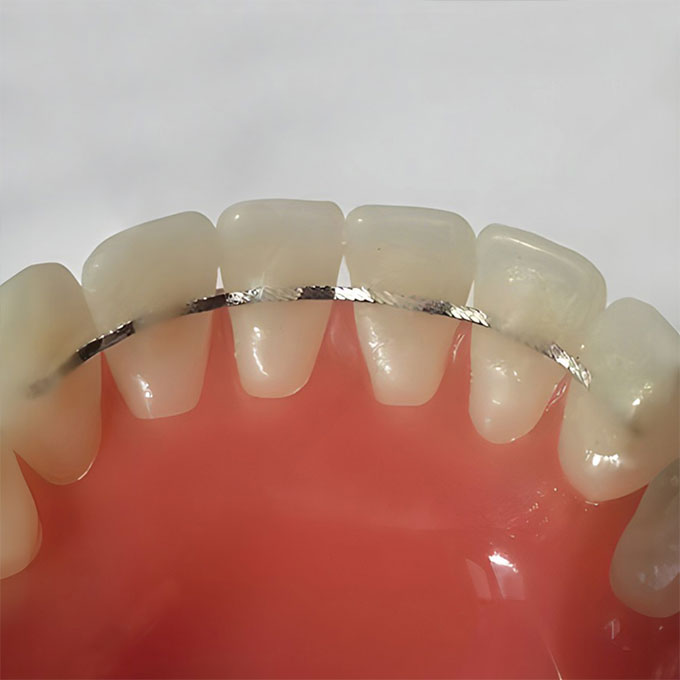 Orthodontic Retainers in Greensboro, Asheboro & Archdale | Grinz ...